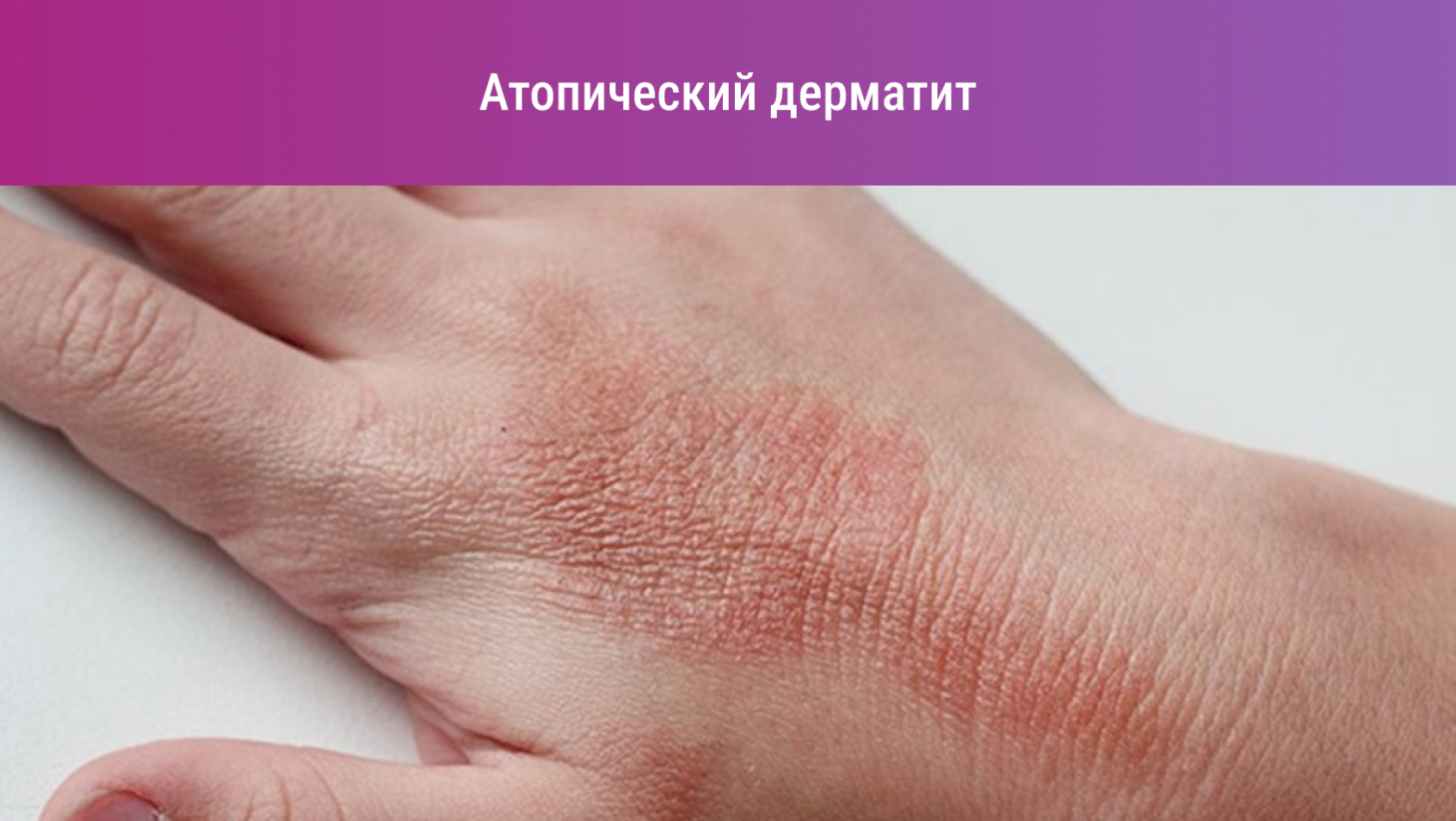 Аллергия на руках всё о причинах и лечении